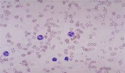 Lecture Part X Microcytic Anemias Flashcards Quizlet