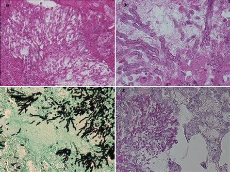 Histological Cross Section Exhibiting Invasive Pulmonary Aspergillosis