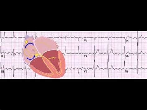 Pasos Para Leer Correctamente Un Electrocardiograma Youtube