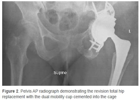 Intraprosthetic Dislocation After A Revision Hip Replacement A Case Report