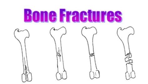 Bone Fractures Diagram Quizlet