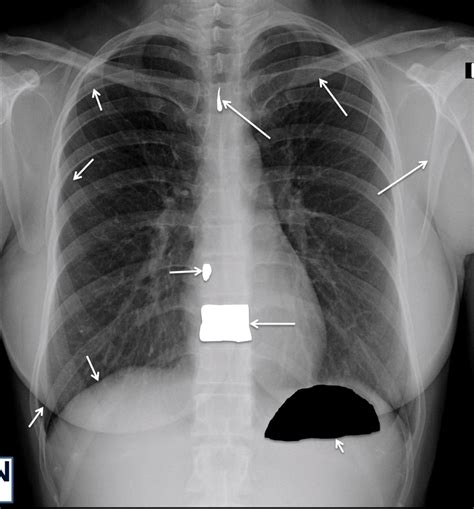 Frontal Chest Radiograph Lungs And Bones Diagram Quizlet
