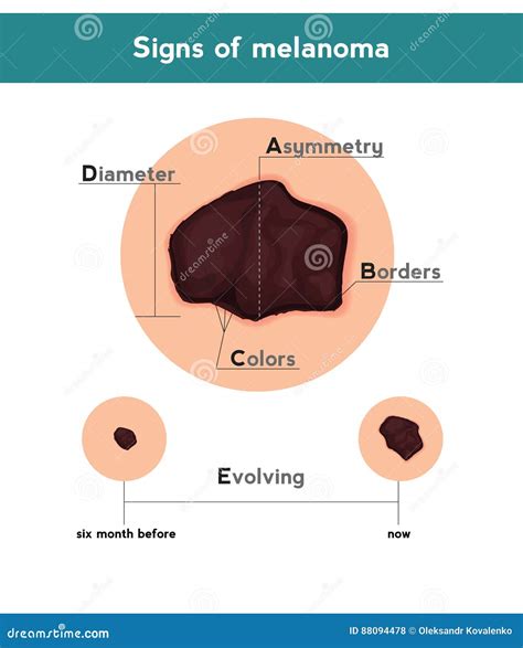 Signes Du Mélanome ABCDE Illustration De Vecteur De Correction De Peau