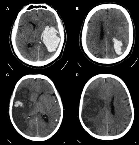 TC cerebro sin contraste cortes axiales caso Nº 3 A B y caso Nº 4