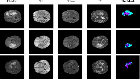figure 1 from an automatic brain tumor segmentation using 3d residual u net semantic scholar