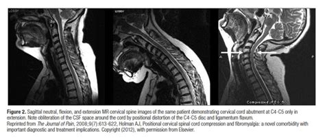Cervical Spine Mri Comparison