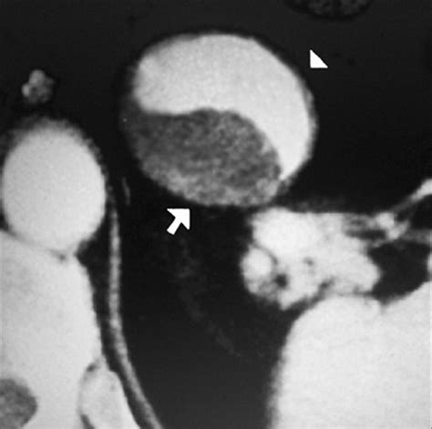 ABC Radiology Blog The Yin Yang Sign