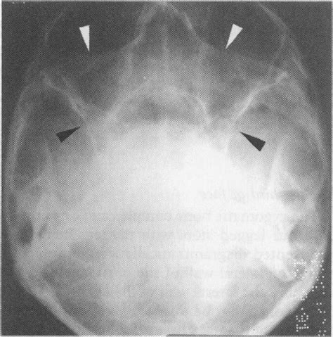 Uccipitomental View Snowing A Lefort Fracture Fractures Are Visible