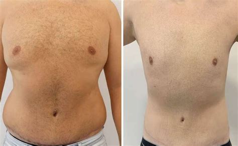 Abdominoplasty In Men Requires Additional Postoperative Care Gossipify