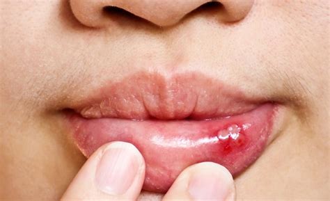 Aciklovir mast upotreba za herpes oči usne i zdravlje iskustva i cena