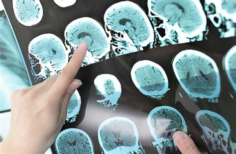 Nuevos Avances En El Tratamiento De La Esclerosis M Ltiple Misionesonline