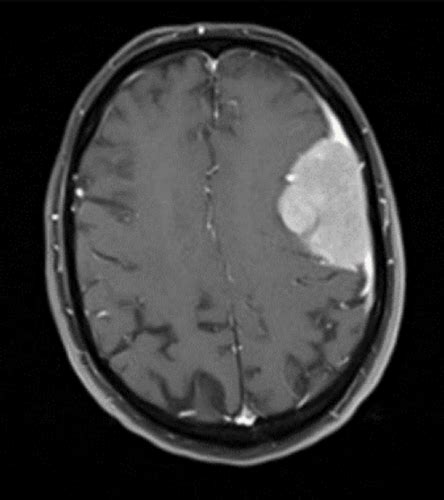 Neuro Oncology Flashcards Quizlet