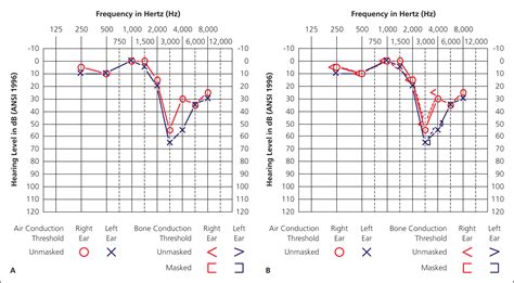 Audiometry Screening And Interpretation AAFP