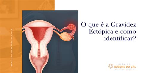 O que é a Gravidez Ectópica e como identificar Clínica Rubens