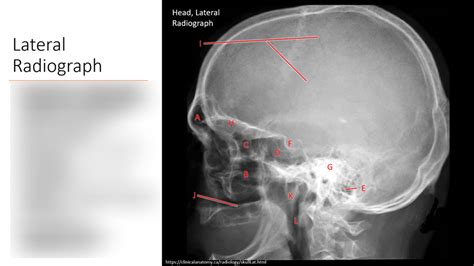 Lateral Radiograph Diagram Quizlet