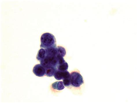 Lung Cytopathology Bronchial And Aspiration Cytology PMC