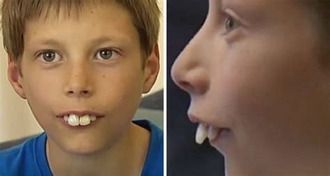 Moqué pour ses dents depuis sa naissance voici à quoi ressemble