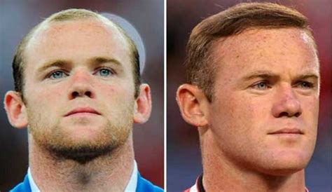 travesura Recuerdo maíz implante de cabello antes y despues Dalset