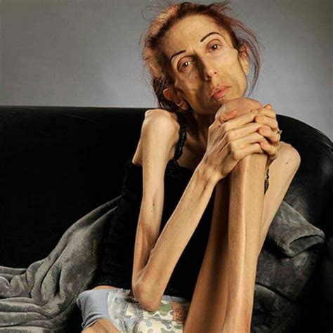Rachel Farokh 10 Yrs Aneroxic