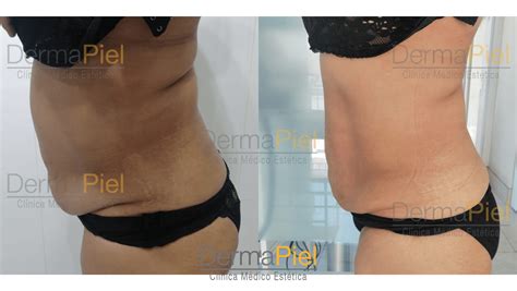 Hidrolipoclasia Antes Y Despues Dermapiel