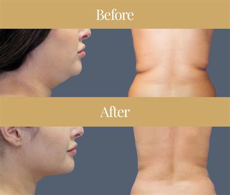 Everything You Need To Know About CoolSculpting ELITE The Devonshire