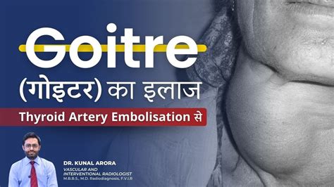 Thyroid Artery Embolization Treating Thyroid Nodules And Goiters