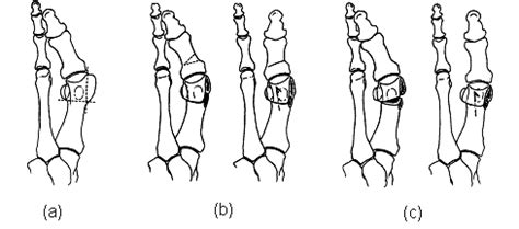 The Distal Chevron Osteotomy And Variation A Surgical Planning Of