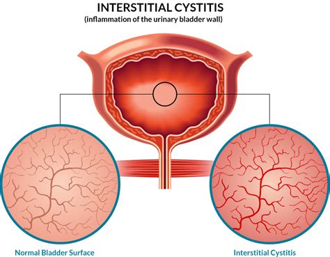 Interstitial Cystitis IC Causes Symptoms Diagnosis Treatment