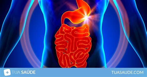 Síndrome do intestino irritável o que é sintomas e tratamento Tua Saúde