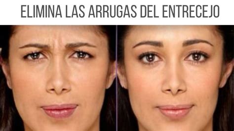 Resumen de 15 artículos como quitar arruga entrecejo actualizado
