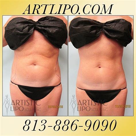 Artistic Liposuction Center Dr Thomas Su Google Liposuction