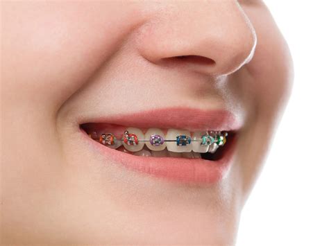 Orthodontics Fixed Braces Ceramic Metal Fast Braces