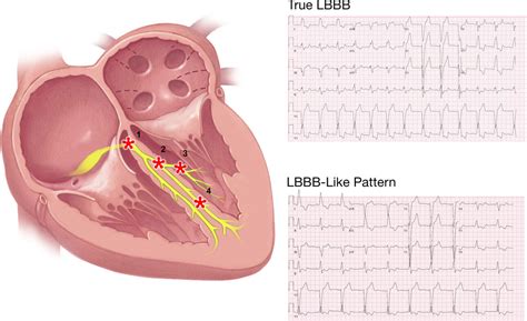 left bundle branch block circulation arrhythmia and electrophysiology