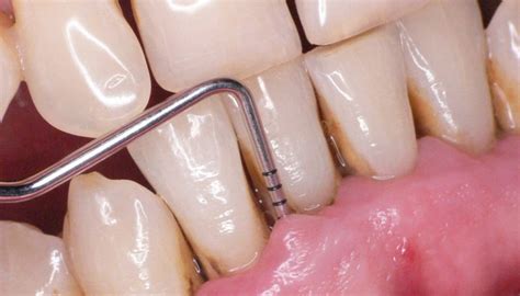 Periodoncia para qué sirve Odontotecks