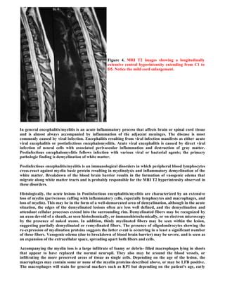 Case Record Neuromyelitis Optica Pdf