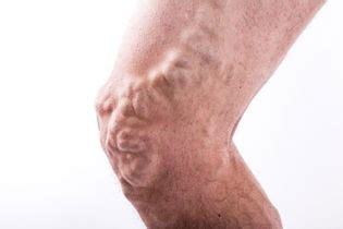 Tromboflebite Como Identificar E Tratar Tua Sa De