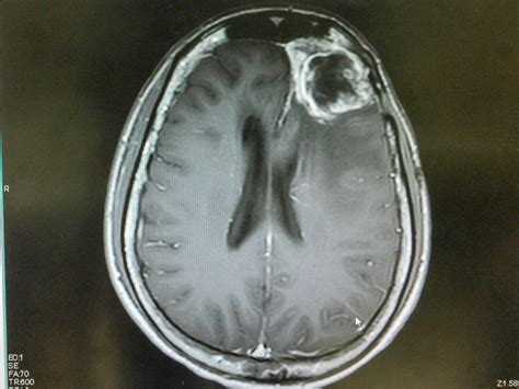 Glioblastoma What Every Patient Needs To Know Glioblastoma Foundation