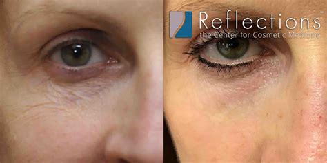 Best Makeup For Crepey Skin Under Eyes Informacionpublica Svet Gob Gt
