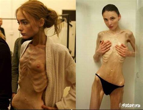 Naked Anorexia Anorexia Makes People Beautiful Anorexia Makes People