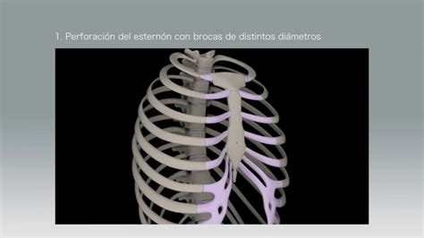 Soluci N Para Pecho Hundido Pectus Excavatum Pectus Up Youtube
