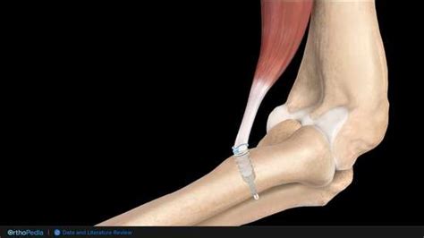 Distal Biceps Tendon Injuries Literature Review On Onlay Vs Inlay