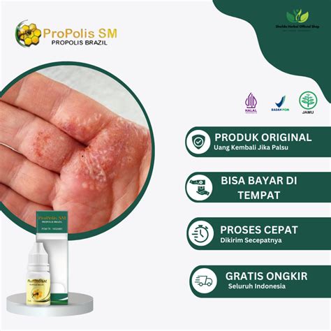 Jual Obat Kutu Air Bintik Bening Berair Gatal Di Sela Jari Bintik Ait