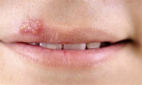 Pin En Herpes Cure