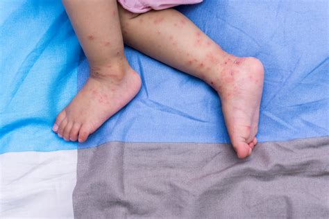 Virus Coxsackie qué es y cómo prevenirlo