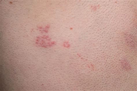 Siempre que hablamos de herpes hablamos de herpes Zóster Yo Dona