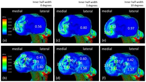 jfmk free full text simulating knee stress distribution using a computed tomography based