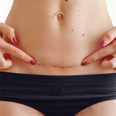 Como tratar Cicatrices Clínica Dermatológica Trigoso