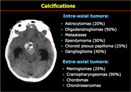 The Radiology Assistant Brain Tumor Systematic Approach