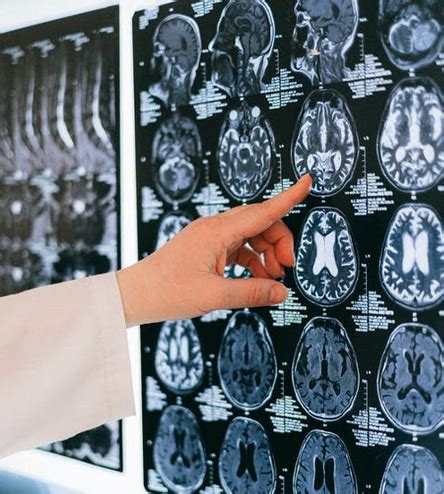 DAÑO CEREBRAL ADQUIRIDO QUÉ ES QUÉ TIPOS EXISTEN Y QUÉ PUEDE