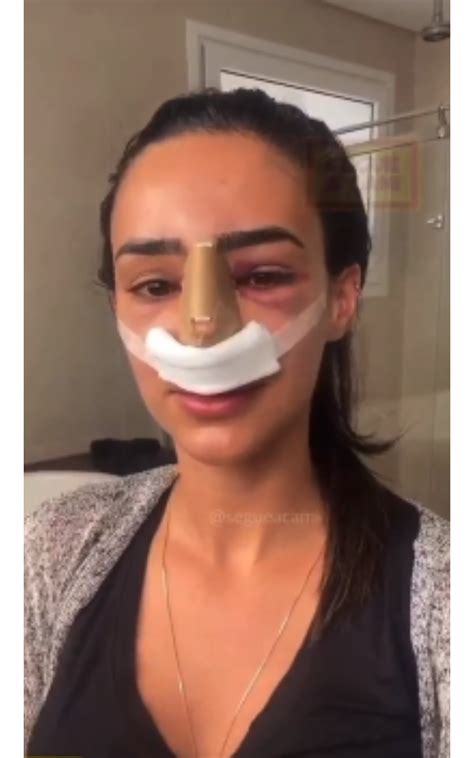 Foto Bruna Biancardi Exibiu O Processo Antes Durante E Depois Da